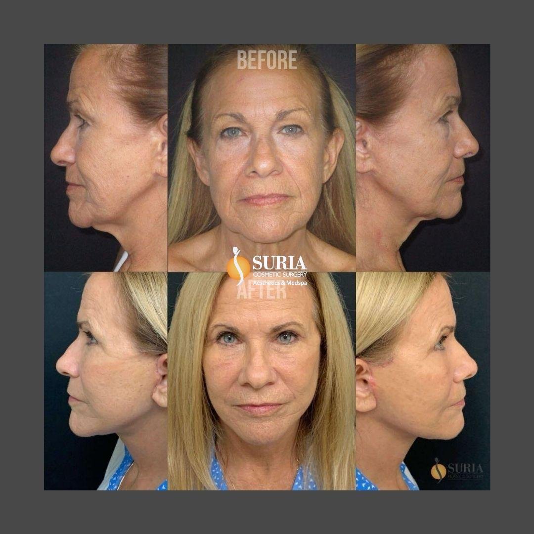 Facelift Before and After Gallery | #1 Best face doctor of Florida