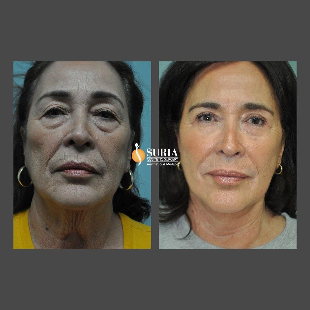 Facelift Before and After Gallery | #1 Best face doctor of Florida