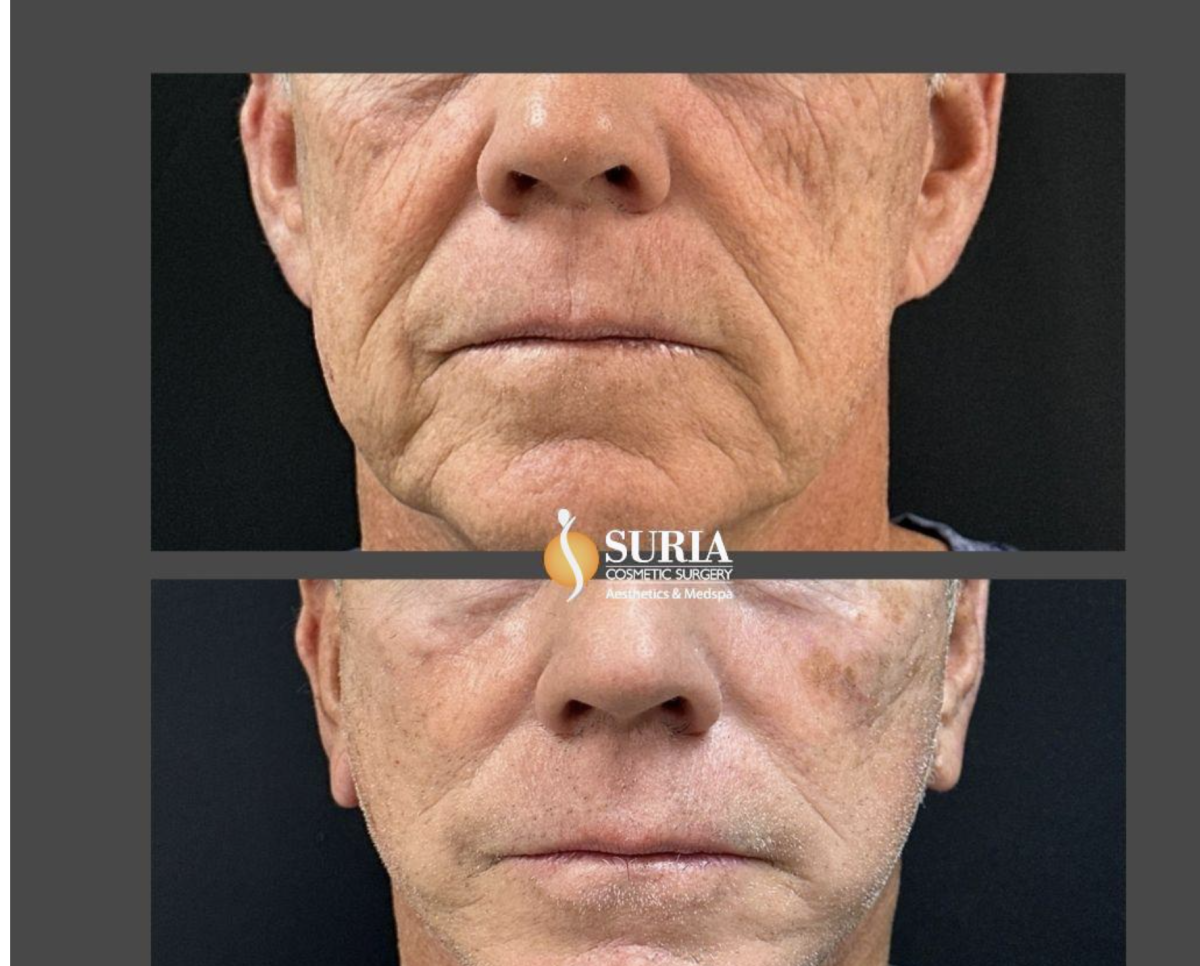 Dr Facelift Gert Erfahrungen
